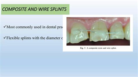 Splinting Of Traumatized Teeth Pptx