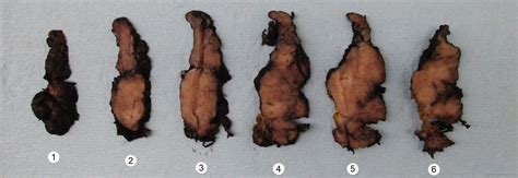 Chronic Lymphocytic Thyroiditis Ottawa Atlas Of Pathology