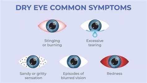 What Causes Dry Eye Syndrome Trockenes Auge Diagnose Kjlqw