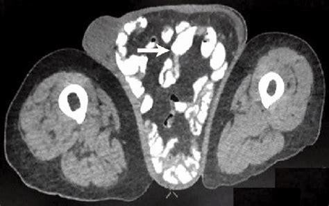Horizontal Computed Tomography Of A 67 Year Old Man With A Download Scientific Diagram