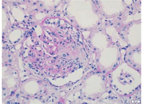 Renal Biopsy Showed Global 4 23 Or Segmental 6 23 Download