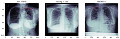 พัฒนาโปรแกรม Ai การแพทย์ วินิจฉัยภาวะปอดรั่ว Pneumothorax อัตโนมัติ จากฟิล์ม X Ray โดยใช้