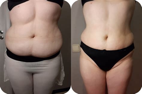 ЕСТЬ ЛИ СМЫСЛ ПРОХОДИТЬ КУРС АППАРАТНОГО МАССАЖА БЕЗ ДИЕТЫ 路‍♀Довольно часто наши клиенты