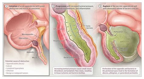 Acute Appendicitis Emedicodiary