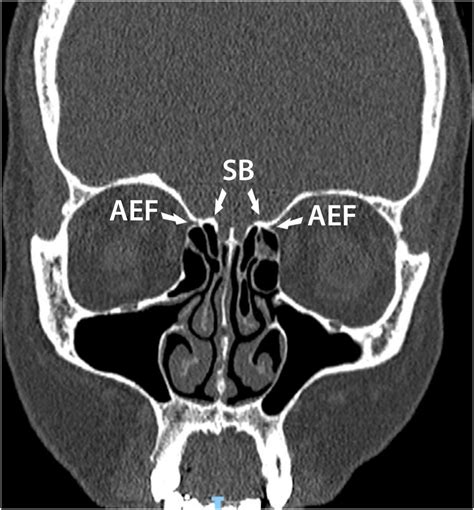 Asymmetry Of The Anterior Ethmoidal Artery In Relation To The Anterior