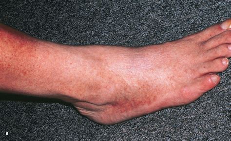 White Spots On Skin Blood Circulation At Lois Coffman Blog