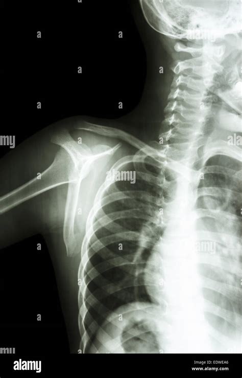 X Ray Shoulder Lateral View