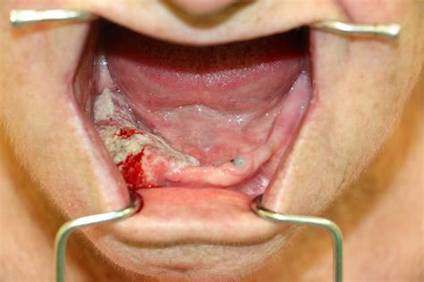 Advanced Scc Of The Lower Gingiva In A 78 Year Old Female Download