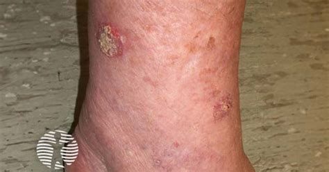 Intraepidermal Carcinoma Image Intraepidermal Carcinoma Image