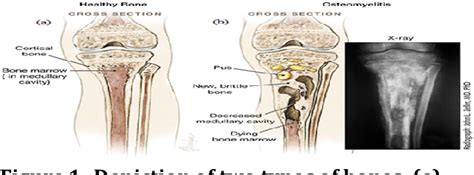 Figure 1 From Development Of Biodegradable Scaffolds Loaded With Vancomycin Micropartricles For