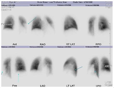 Lung Perfusion Scan Shows A Large Wedge Shaped Perfusion Defect In Left