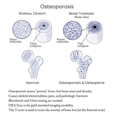 Osteoporosis Definition Health Canada Has Approved A New Osteoporosis