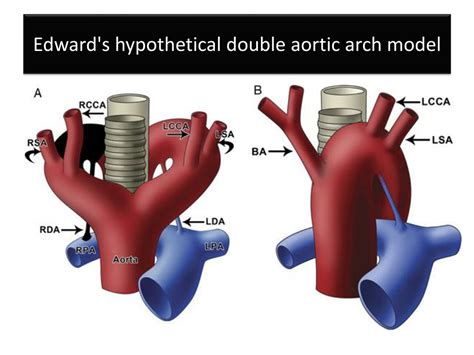 Ppt Aortic Arch Anomalies Powerpoint Presentation Free Download Id
