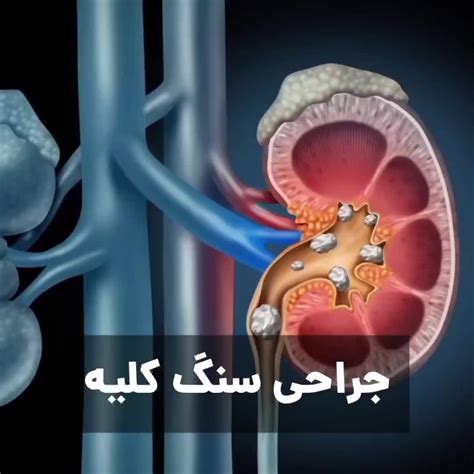 ویدیو جراحی سنگ کلیه