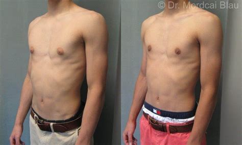 Puffy Nipples Before And After Photos ⋆ Gynecomastia Usa