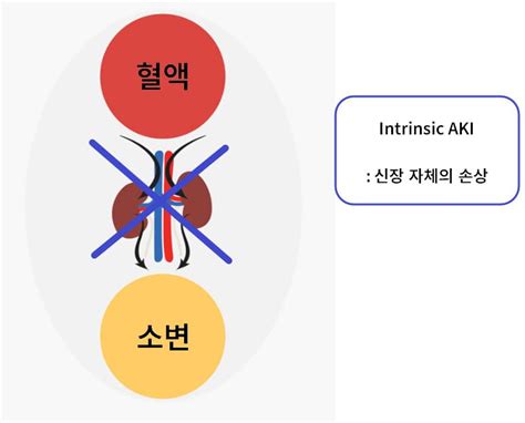 급성 신손상의 감별 Aki Differential Diagnosis 의학당