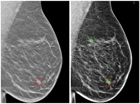 Unsupervised Anomaly Localization In High Resolution Breast Scans Using Deep Pluralistic Image