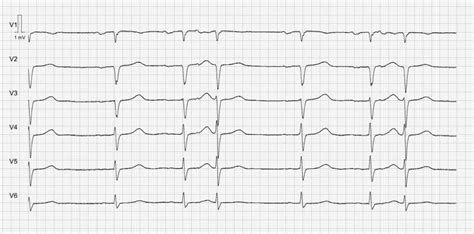 80yo Female Post Syncope Ecg Rekgs