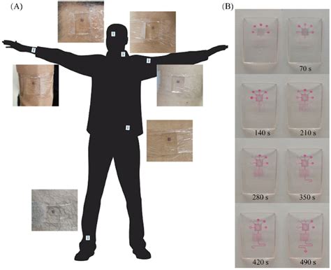 Simultaneous Detection Of Urea And Lactate In Sweat Based On A Wearable