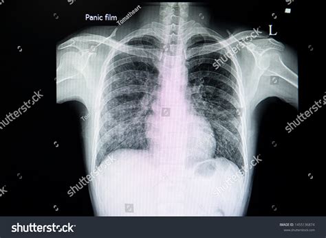 Interstitial Pneumonia X Ray