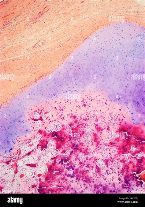 Testicular Cancer Light Micrograph Of A Section Of A Testicular Teratoma Teratoma Is A Type Of