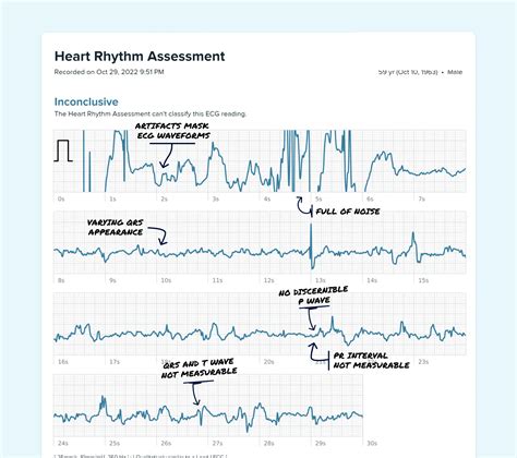 Unreadable Noisy Vs Ventricular Tachycardia Sustained On Your Watch Ecg Qaly