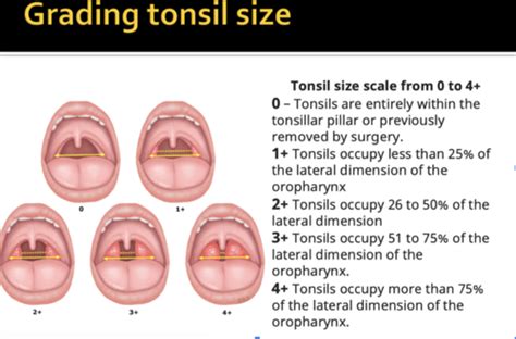 Laryngitis And Pharyngitis Flashcards Quizlet