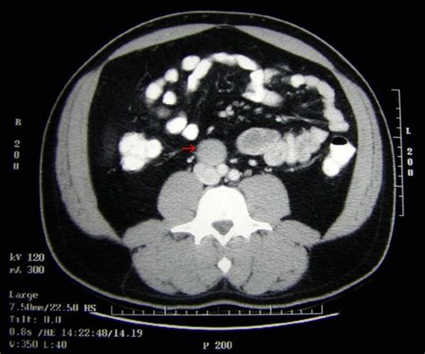 Testicular Cancer Staging