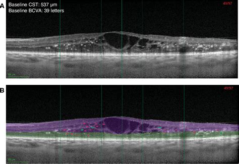 Figure 1 From Intraretinal Hyper Reflective Foci Are Almost Universally