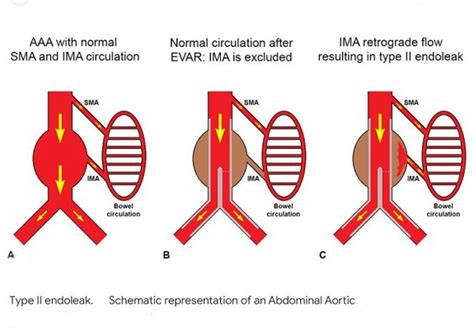 Understanding Type Ii Endoleaks Thailand Medical News