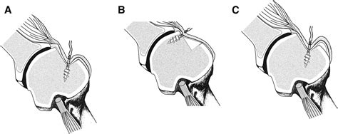 The Shoulder Remplissage Procedure For Hill Sachs Defects Does
