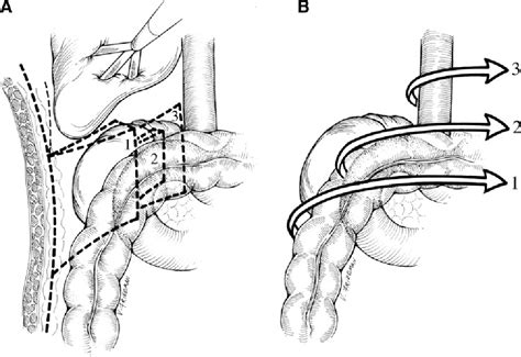 Figure 2 From Laparoscopic Transperitoneal Nephrectomy For Renal Cancer The University Of