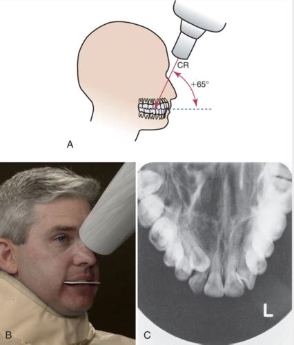 Chapter 23 Occlusal And Localization Techniques Flashcards Quizlet