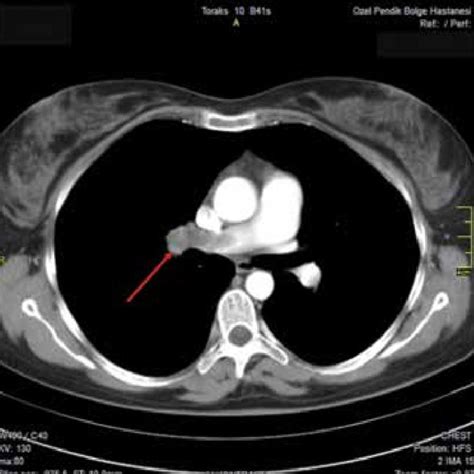 Arrow Shows A Large Contiguous Filling Defect Extending From The Main Download Scientific