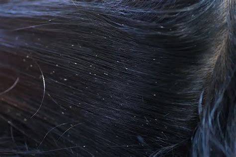 Phantom Lice Syndrome Do You Have Lice Or Are You Paranoid Licedoctors