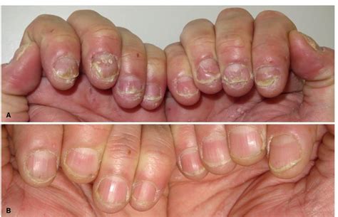 Figure 1 From Effective Treatment Of Nail Psoriasis With Apremilast