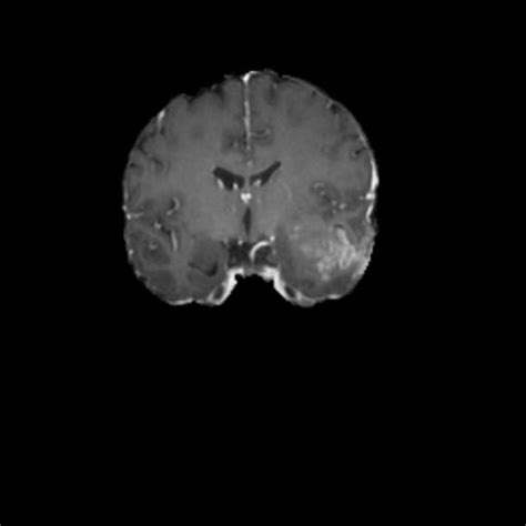 mmenendezg brain tumor object detection · datasets at hugging face