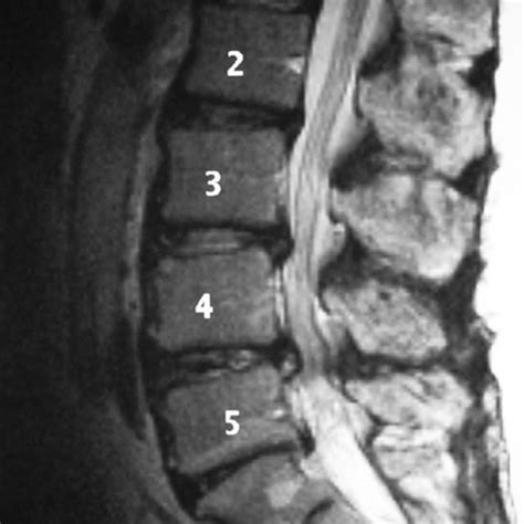 Wide Posterior Decompression And Transpedicular Screw Placement Download Scientific Diagram