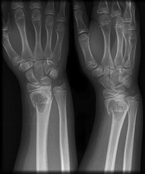 Metaphyseal Pathological Fracture Doccheck