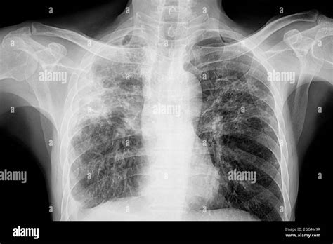 Chest Xray Of The Patient With Lungs Tuberculosis Showing Reticulonodular Opacity Involve Both