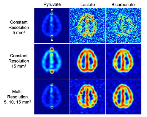 Jasmine Y Graham 1 2 Peder E Z Larson 2 Daniel B Vigneron 2