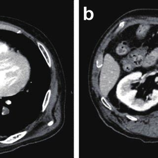 Contrast Enhanced CT Scan Findings Upon Admission On Day 1 208 A Download Scientific Diagram
