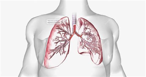Premium Photo Cystic Fibrosis Is A Genetically Inherited Disease That