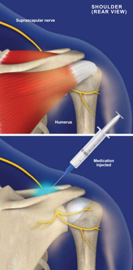Suprascapular Nerve Block Shoulder Pain Injection