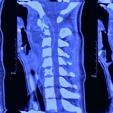 Ct Scan Of The Cervical Spine Download Scientific Diagram