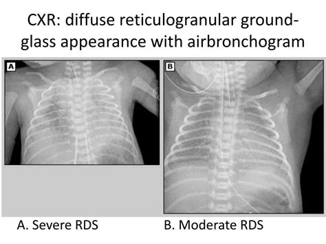 Ground Glass Pattern X Ray At Jennie Wilson Blog