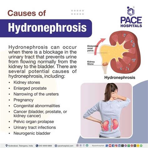 Causes Of Hydronephrosis