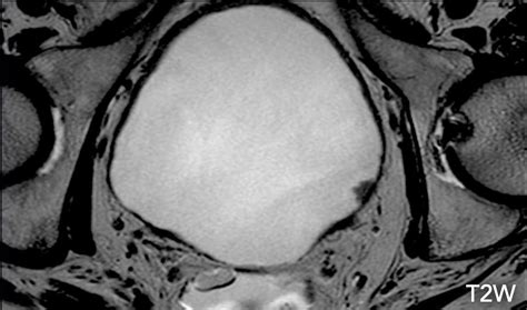 The Radiology Assistant Bladder Cancer Vi Rads