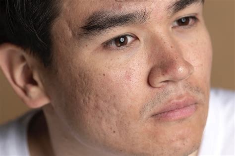 Pitted Acne Scars What Is It Types Causes And Treatment Options