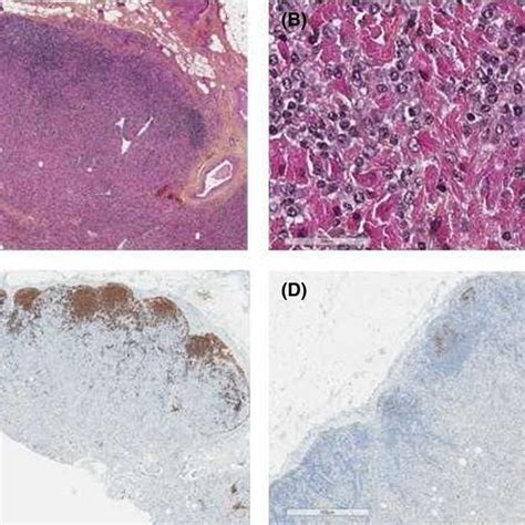 Lymph Node Biopsy Massive Infiltration By The Same Crystalline